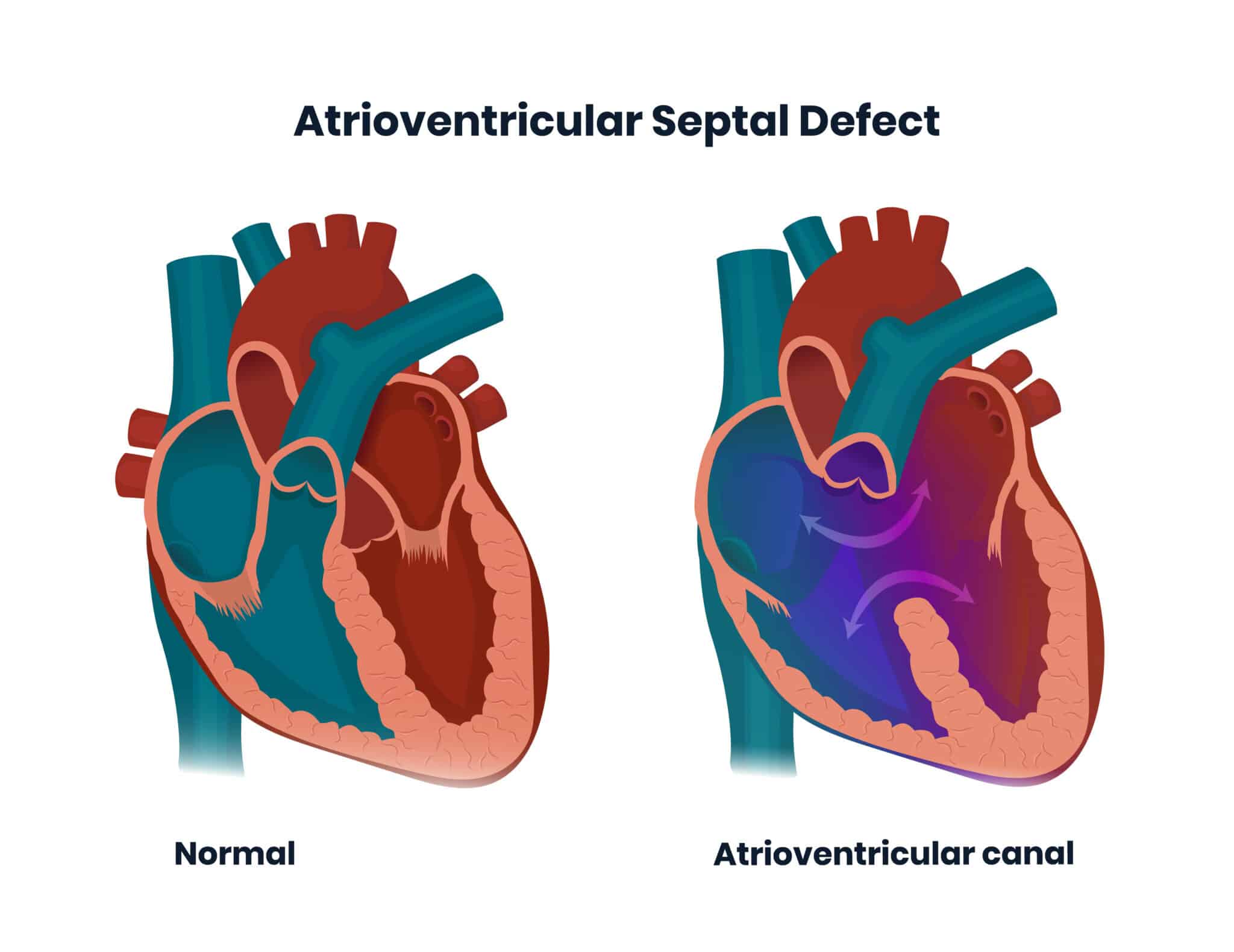 Congenital Heart Defects and Down Syndrome | LuMind IDSC